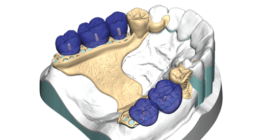 exocad PartialCAD (Perpetual Upgrade)